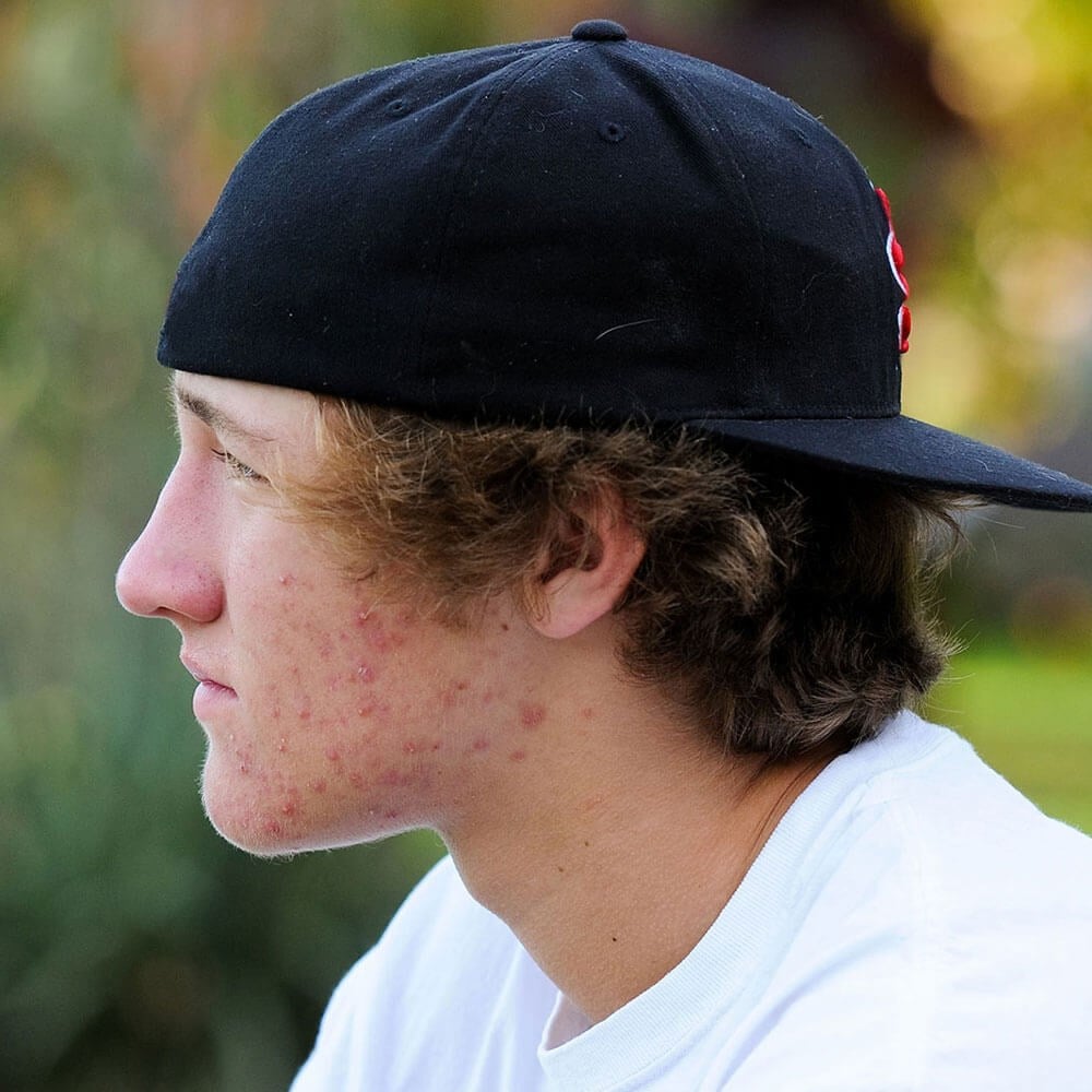 Acne in Devon, PA | Laser & Skin Surgery